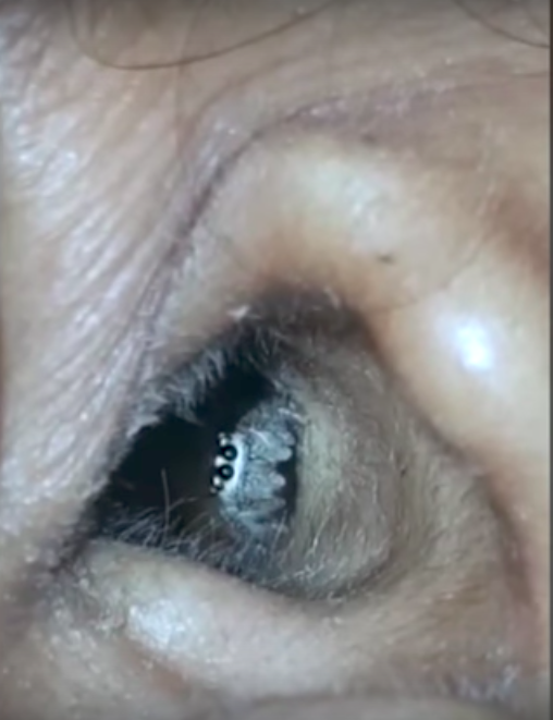 WATCH: Tiny spider crawls out of woman’s ear in India | Inquirer Technology