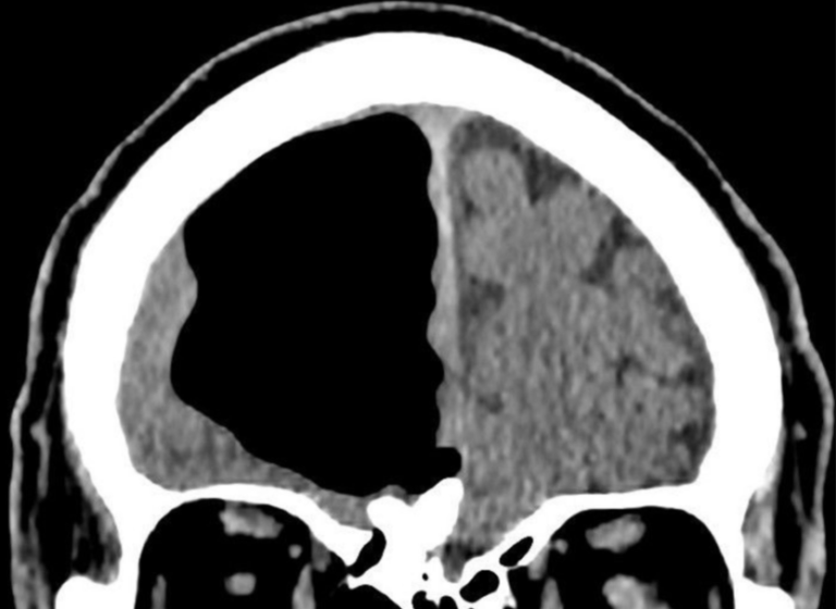 Doctors discover air pocket in man's skull, part of brain missing ...